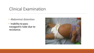 TRACHEO ESOPHAGEAL FISTULA.pptx