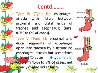 TRACHEOESOPHAGEAL FISTULA hbmjgffddddffg | PPT