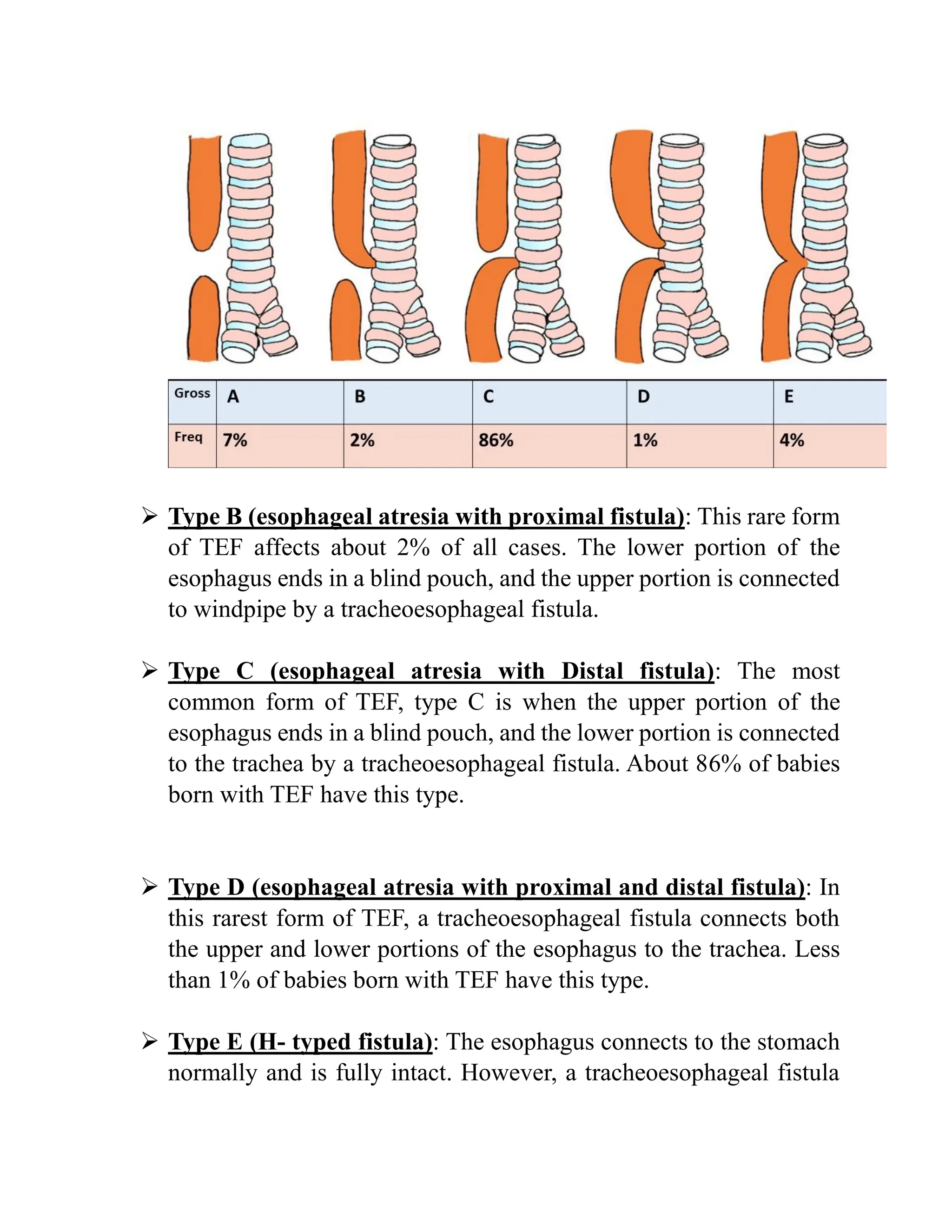 TRACHEOESOPHAGEAL FISTULA.pdf FOR NURSING STUDENTS | PDF