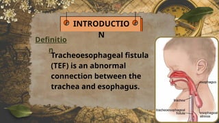 Tracheoesophageal Fistula ( introduction, incidence rate,types ...