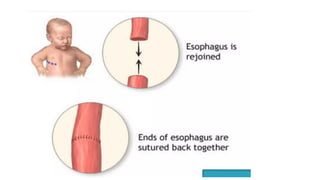 Tracheoesophageal Fistula (TEF) – A Congenital Malformation of the ...