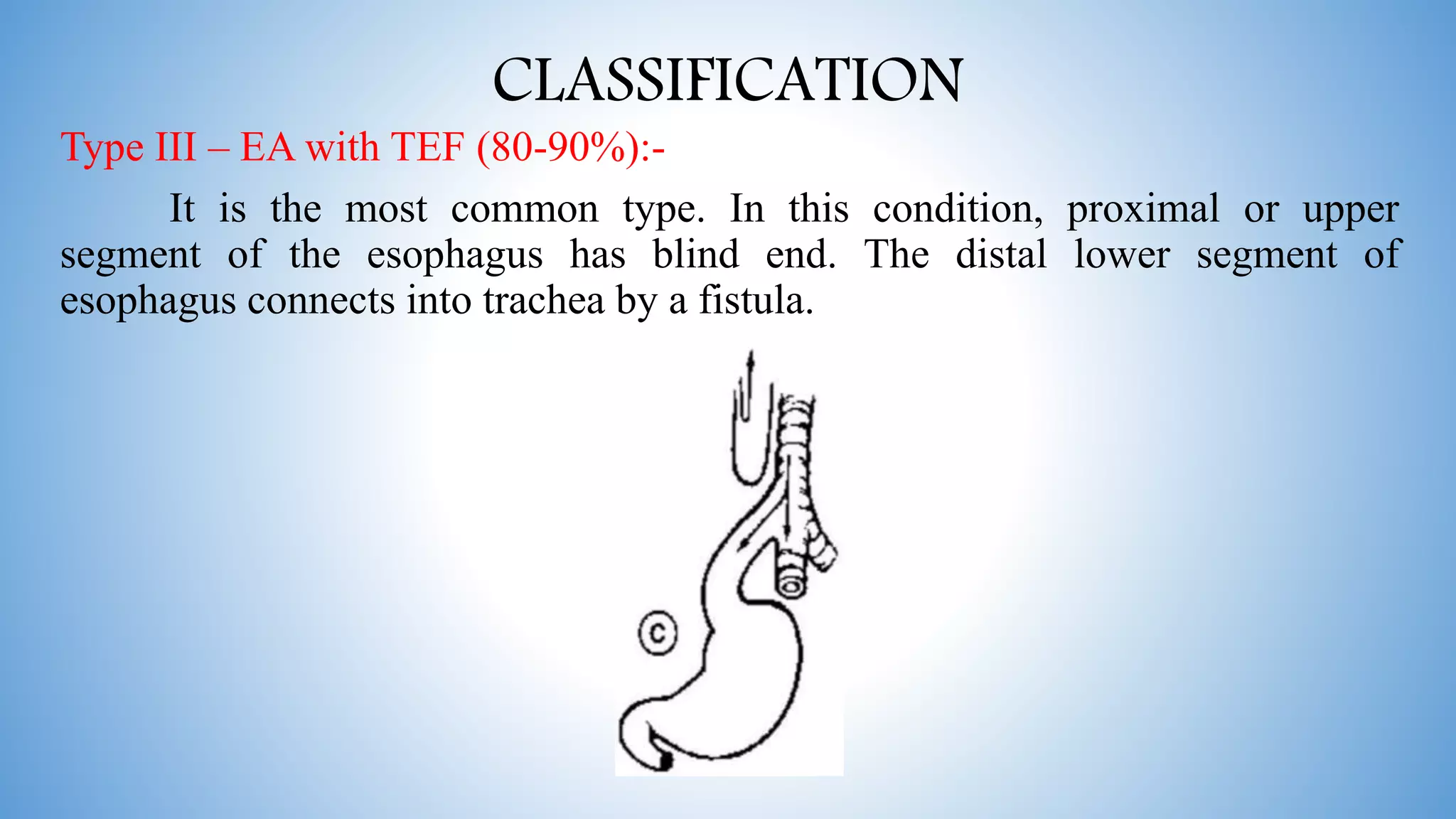 Theosophical fistula and esophageal atresia | PPTX