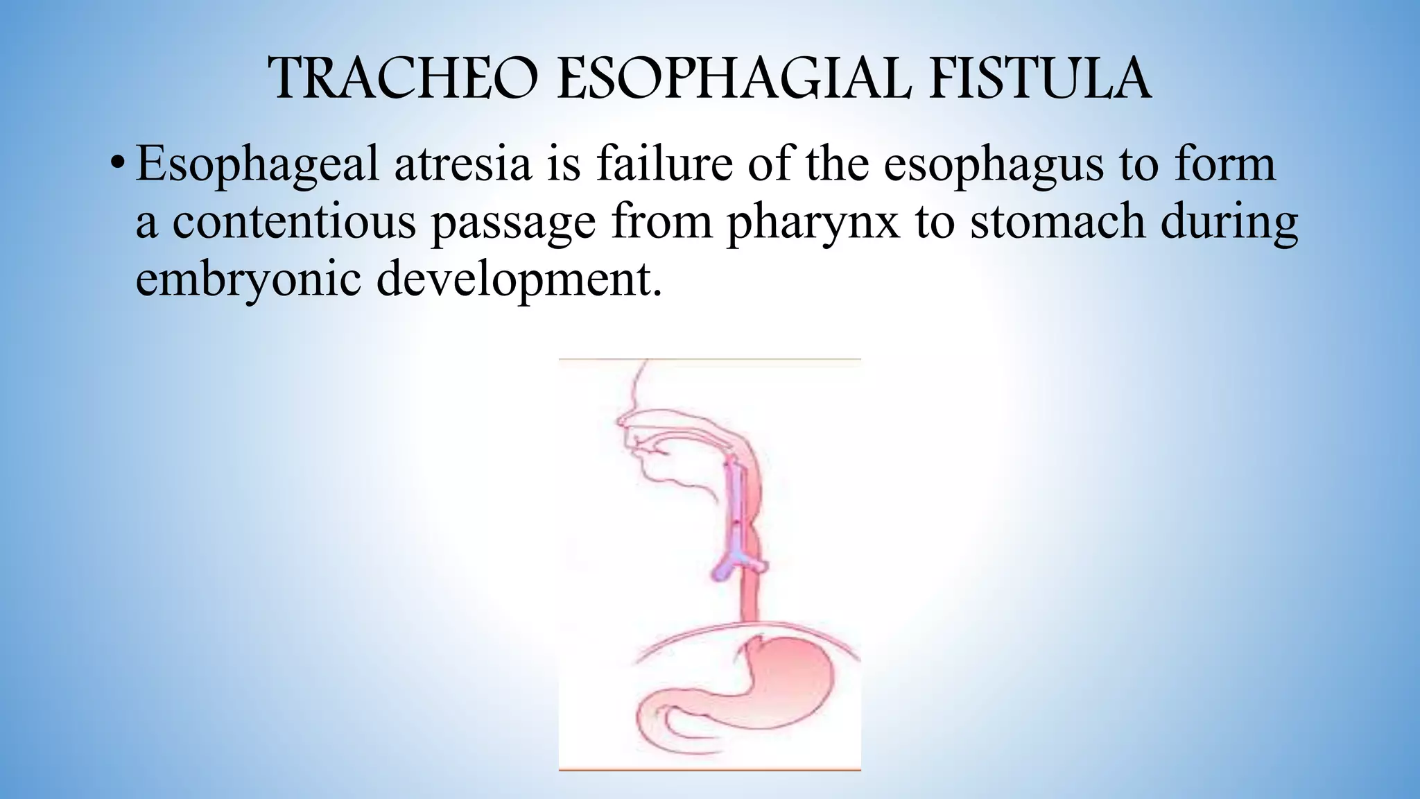 Theosophical fistula and esophageal atresia | PPTX