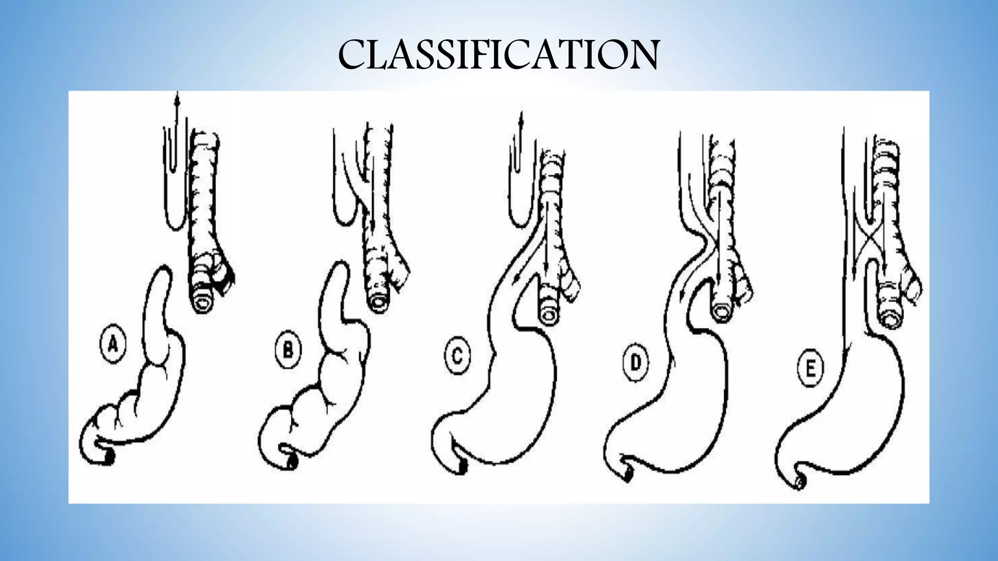 Theosophical fistula and esophageal atresia | PPTX