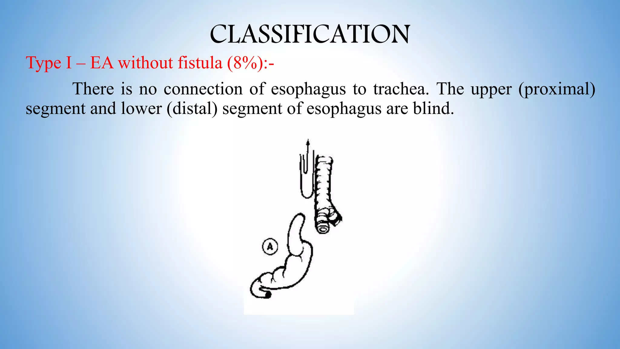 Theosophical fistula and esophageal atresia | PPTX