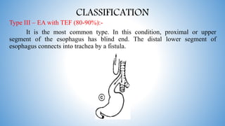 Theosophical fistula and esophageal atresia | PPTX