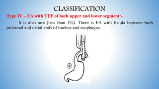 Theosophical fistula and esophageal atresia | PPTX