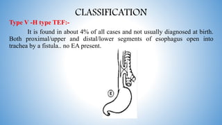 Theosophical fistula and esophageal atresia | PPTX