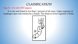 Theosophical fistula and esophageal atresia | PPTX