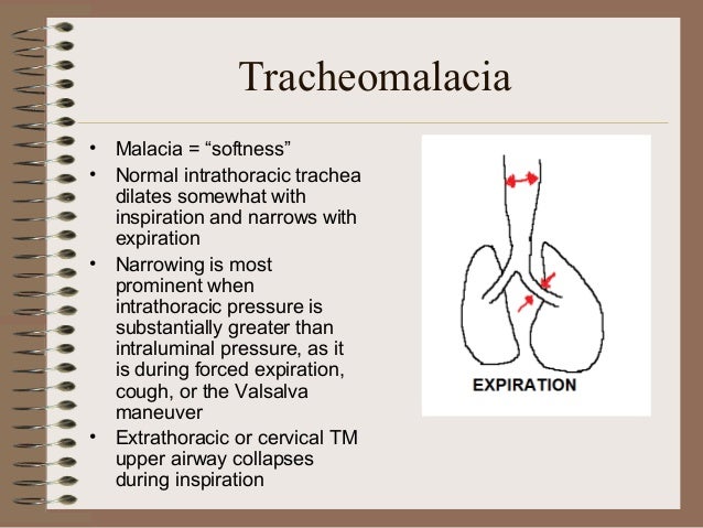 Tracheomalacia