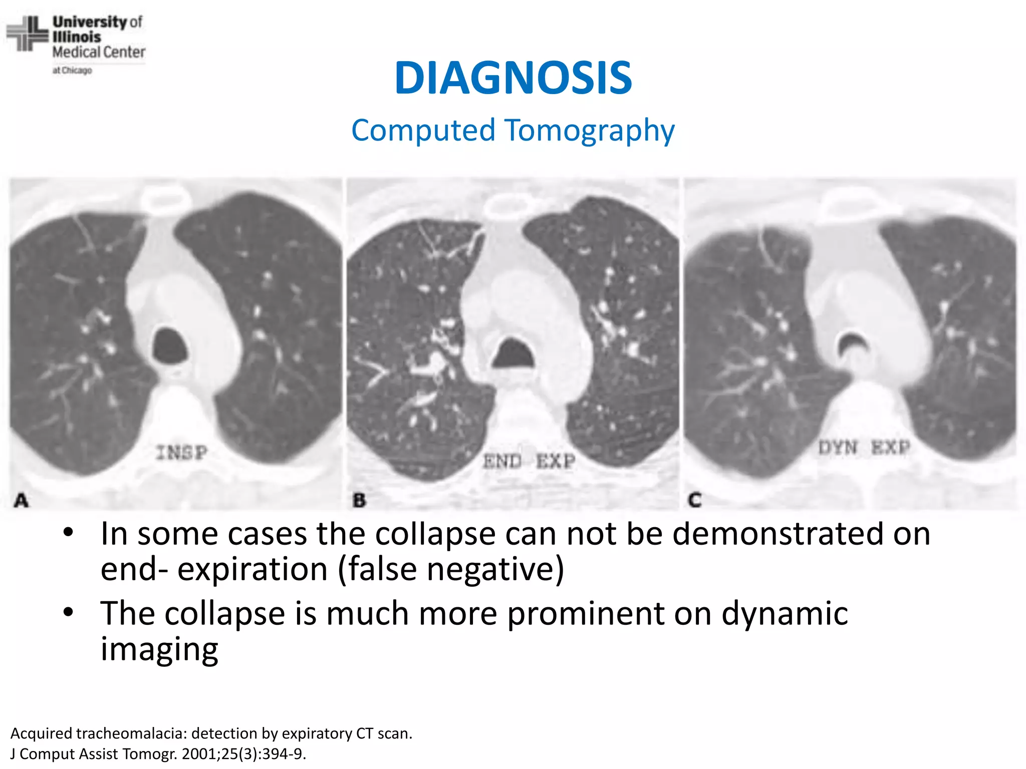Dynamic Central Airway Obstruction: Tracheomalacia ...