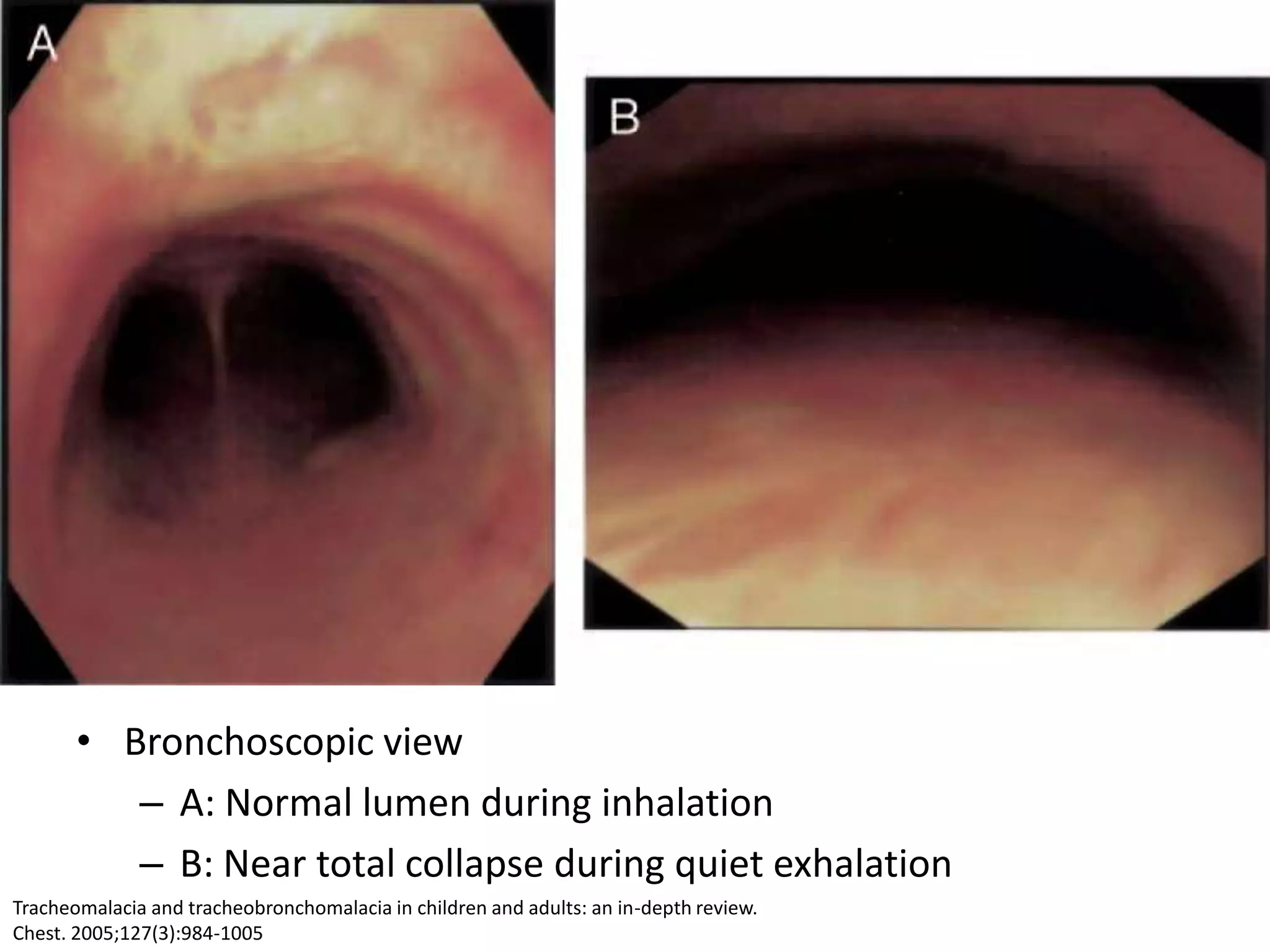 Dynamic Central Airway Obstruction: Tracheomalacia ...