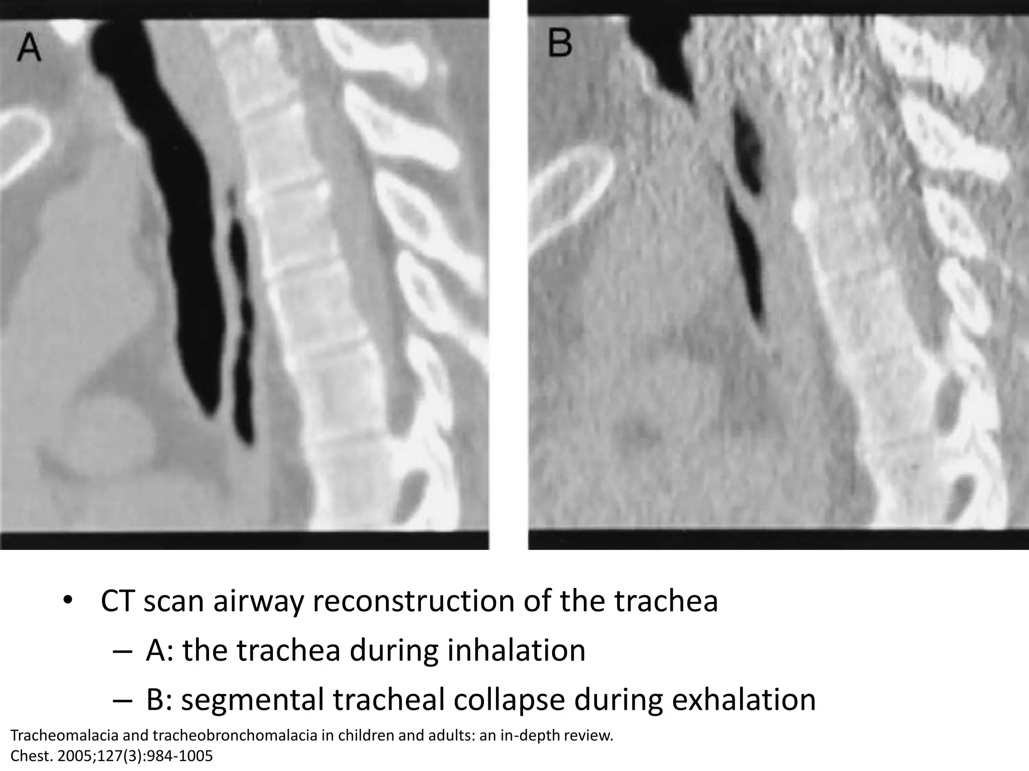 Dynamic Central Airway Obstruction: Tracheomalacia ...