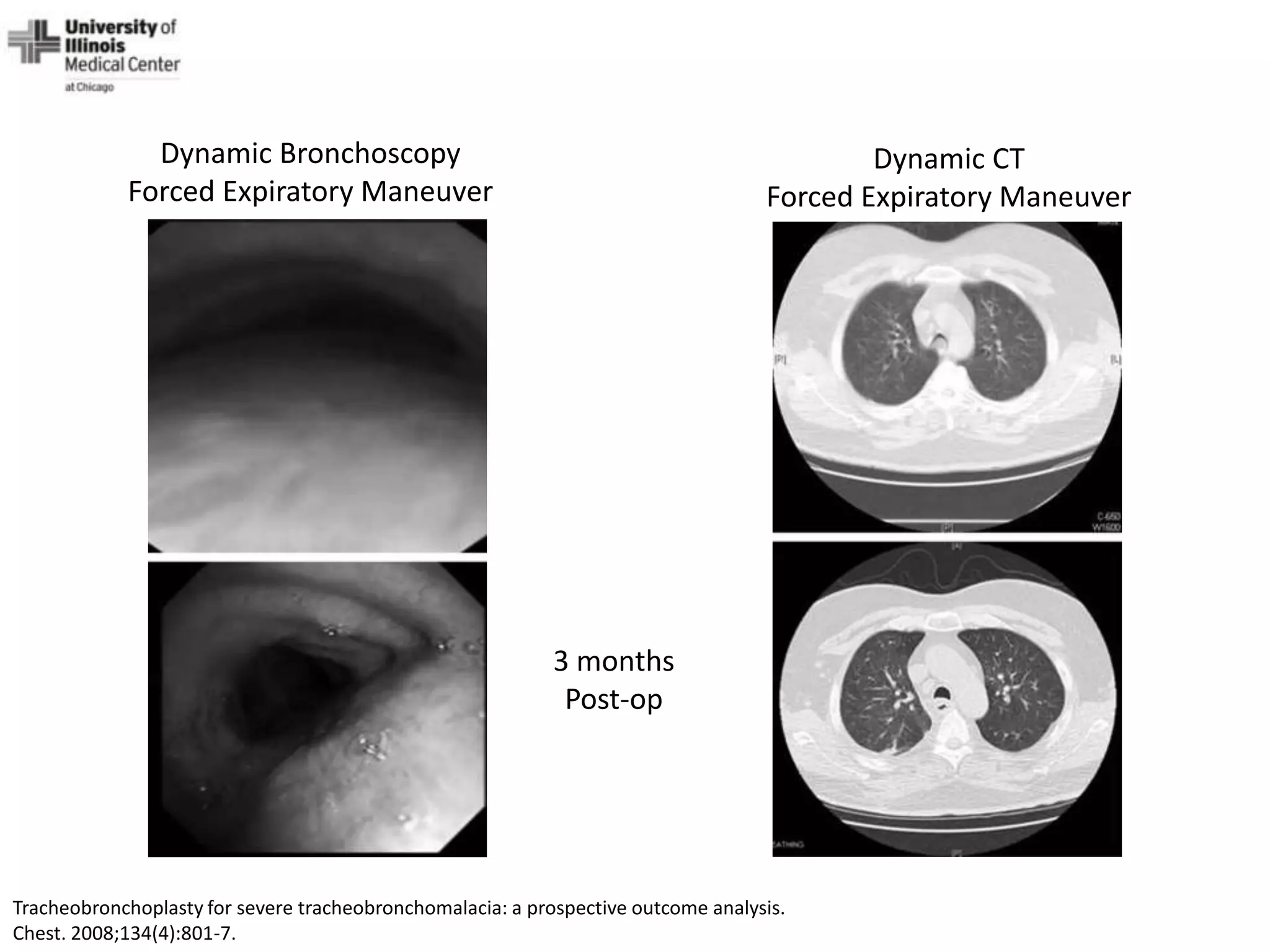 Dynamic Central Airway Obstruction: Tracheomalacia ...