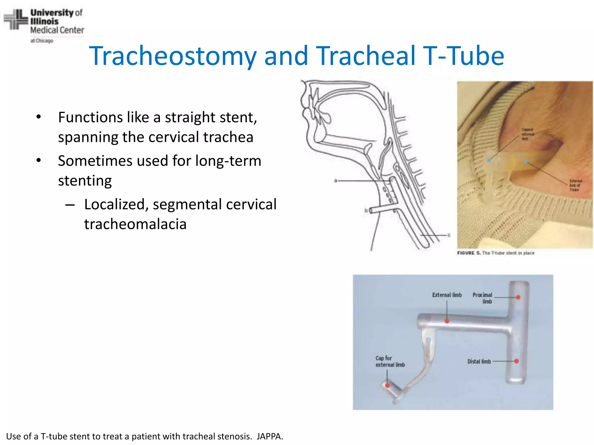 Dynamic Central Airway Obstruction: Tracheomalacia ...