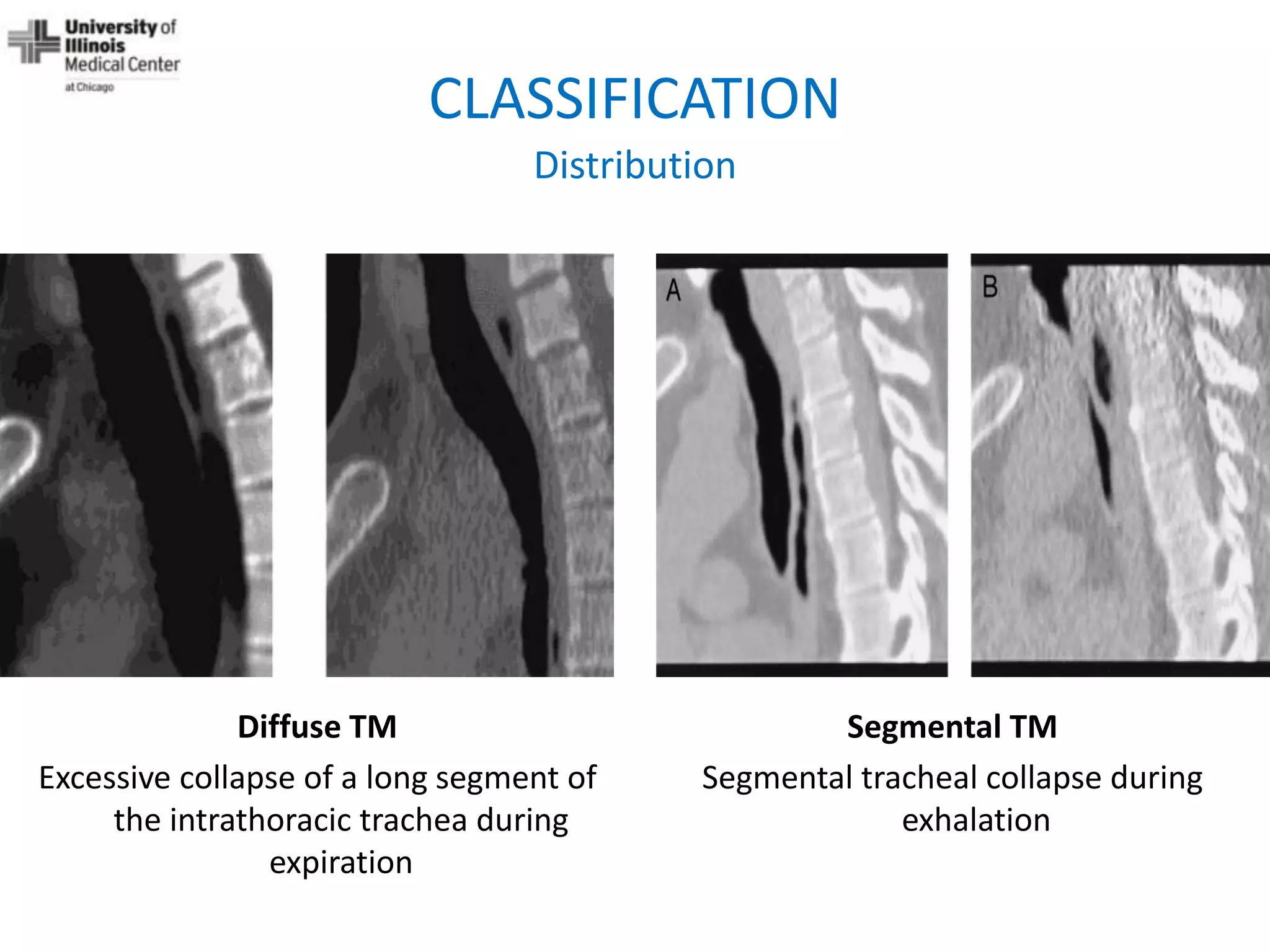 Dynamic Central Airway Obstruction: Tracheomalacia ...