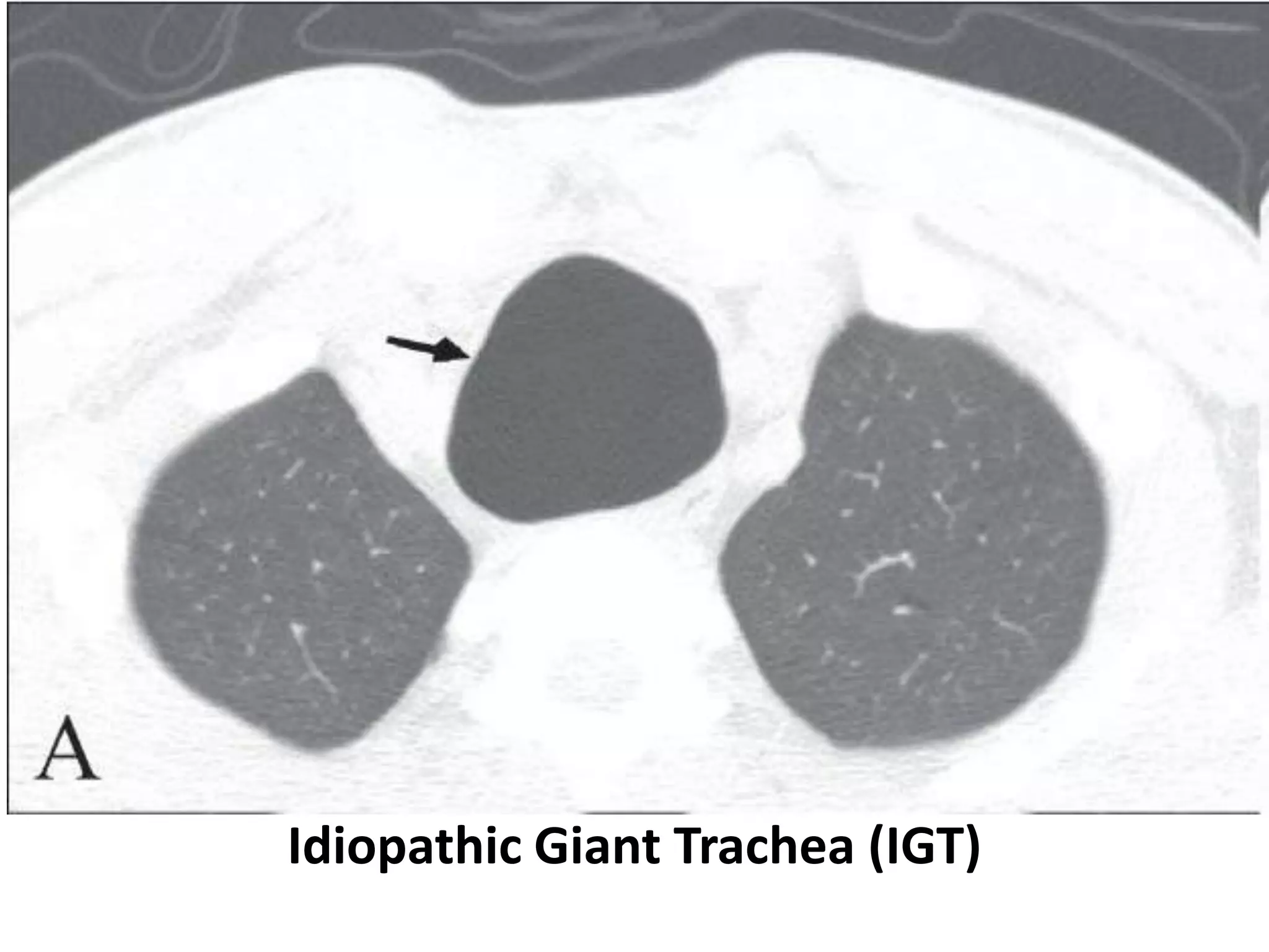 Dynamic Central Airway Obstruction: Tracheomalacia ...