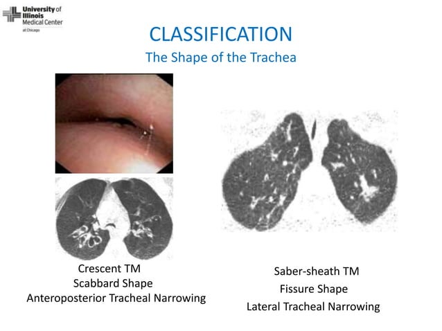 Dynamic Central Airway Obstruction: Tracheomalacia ...