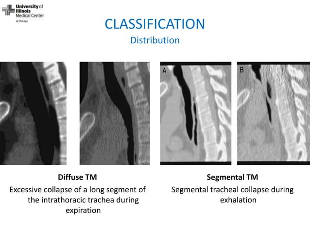 Dynamic Central Airway Obstruction: Tracheomalacia ...