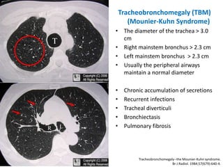 Tracheobronchomalacia