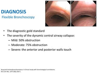 Tracheomalacia Bronchoscopy