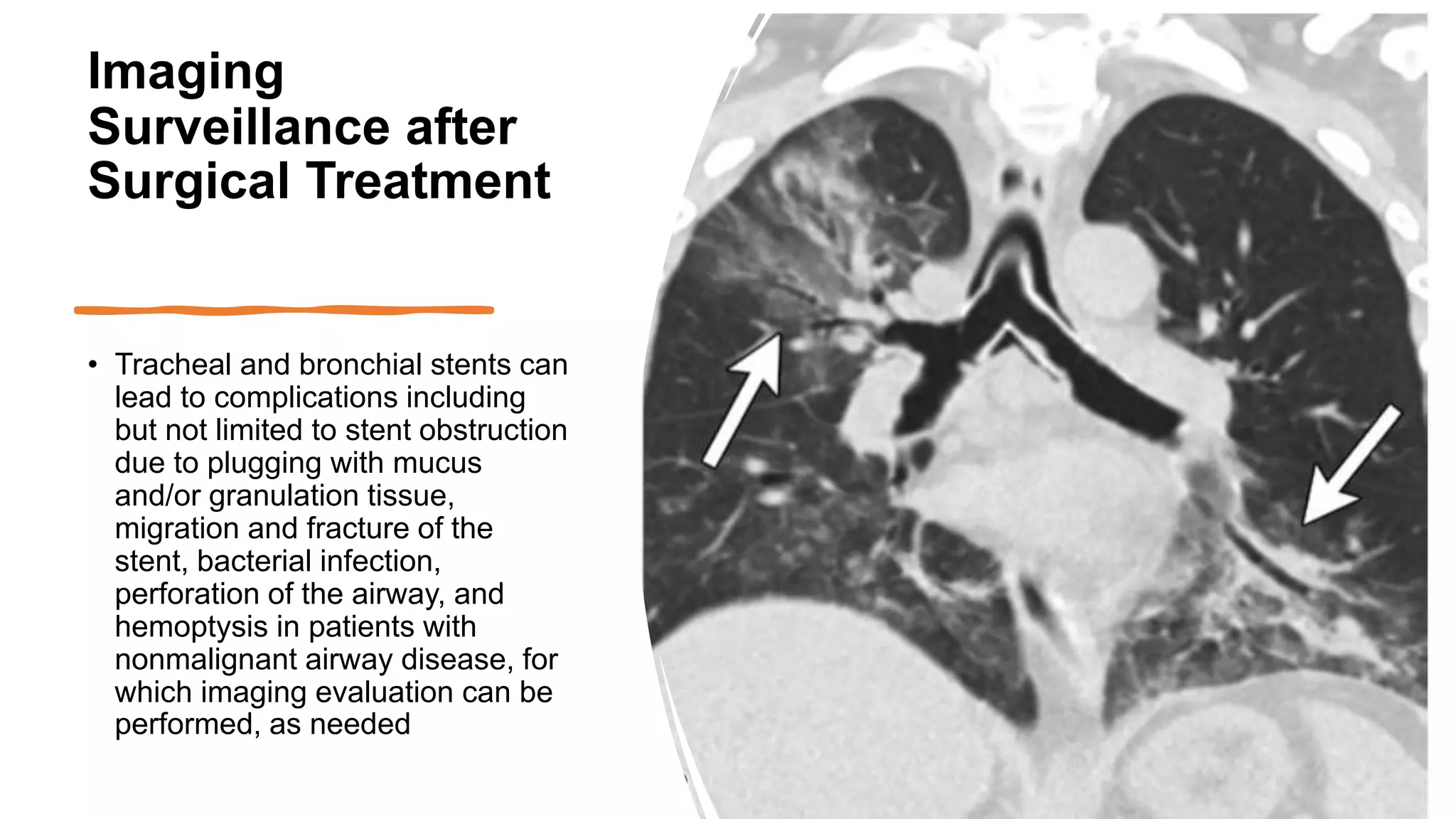 tracheomalcia and edac.pptx