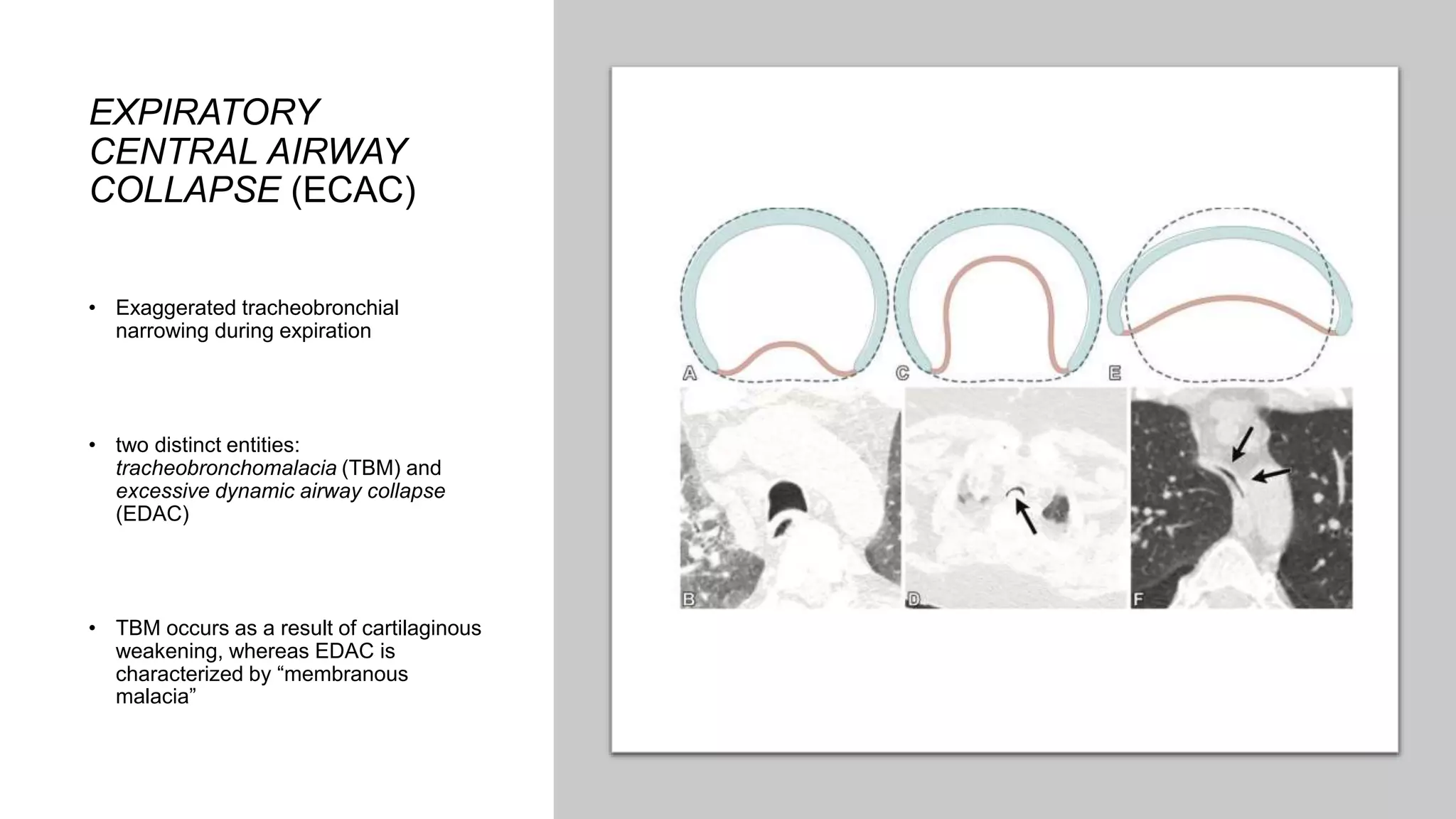 tracheomalcia and edac.pptx