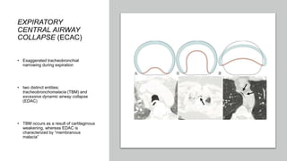 tracheomalcia and edac.pptx