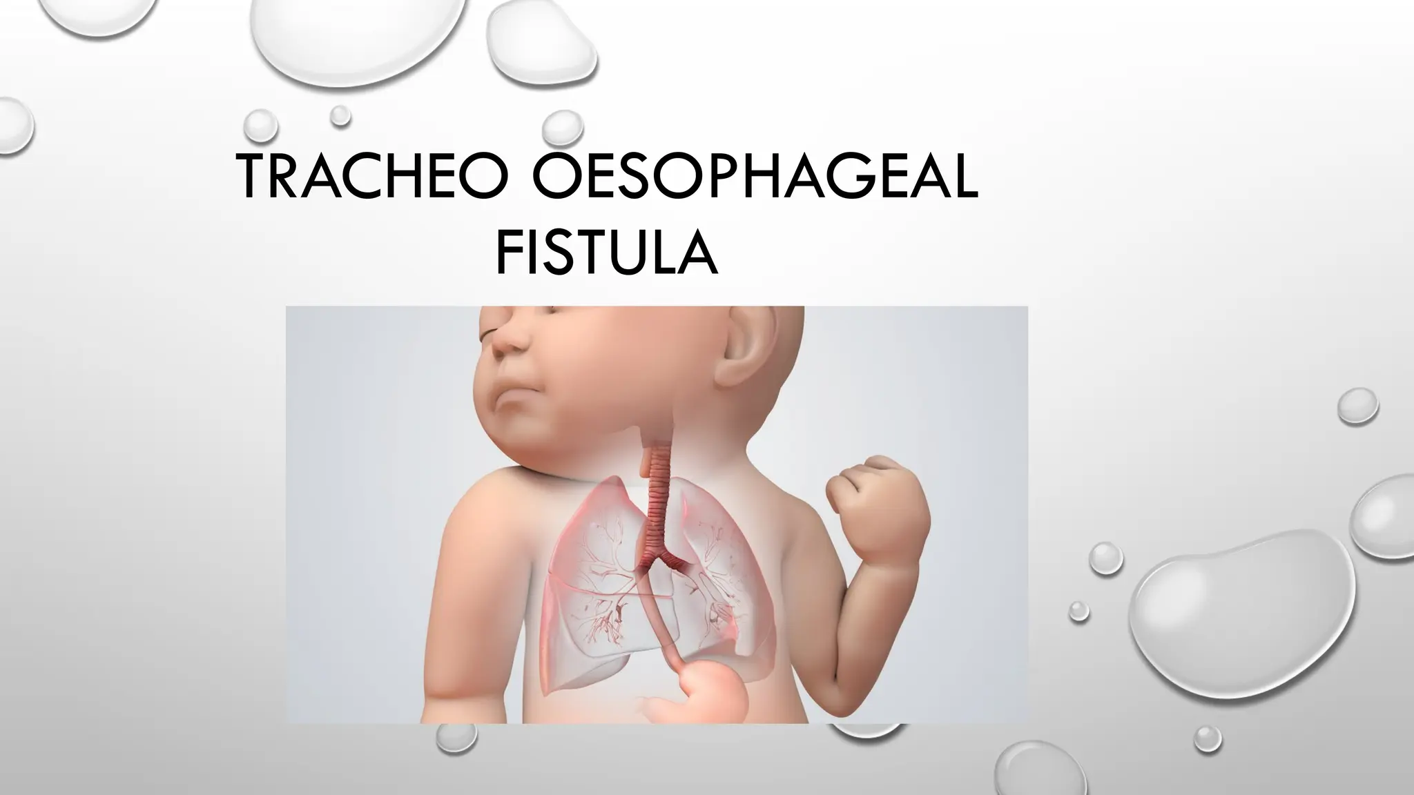 Tracheo oesophageal fistula GIT ok.pptx