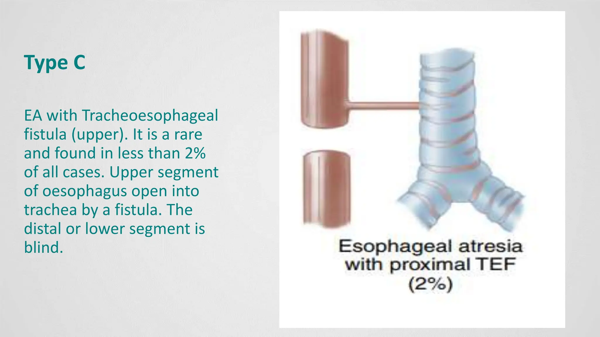TRACHEOSPHAGEAL FISTULA.pptx an abnormalities | PPTX