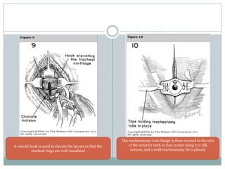 Tracheostomy | PPTX | Thyroid Disorders | Endocrine and Metabolic Diseases