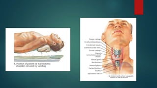 Tracheostomy Operating Technique | PPTX