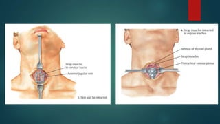 Tracheostomy Operating Technique | PPTX