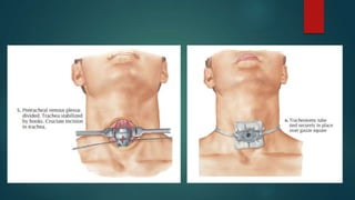 Tracheostomy Operating Technique | PPTX