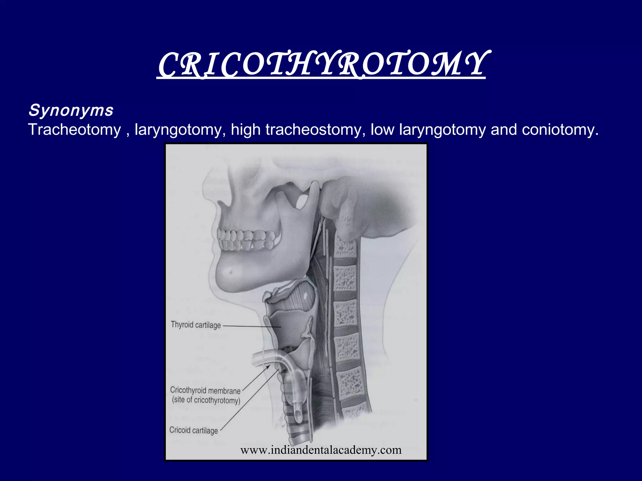Tracheostomy /certified fixed orthodontic courses by Indian dental ...