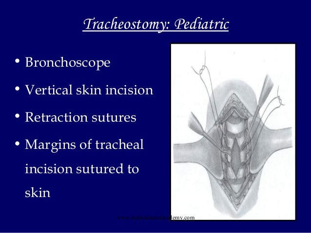 Tracheostomy /certified fixed orthodontic courses by Indian dental ac…