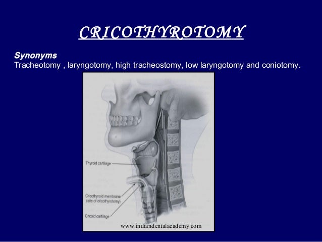 Tracheostomy /certified fixed orthodontic courses by Indian dental ac…