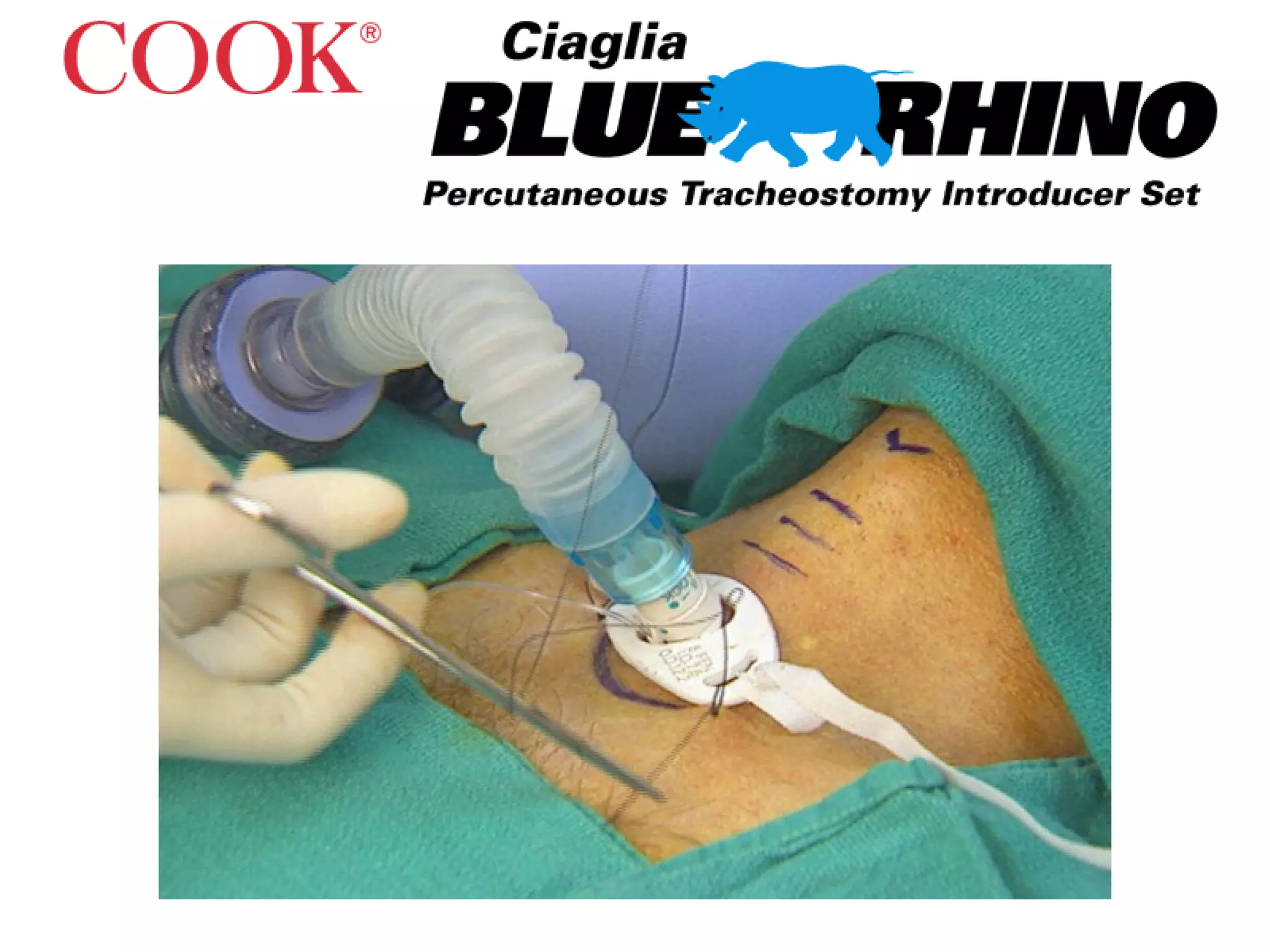 Percutaneous Tracheostomy | PPT