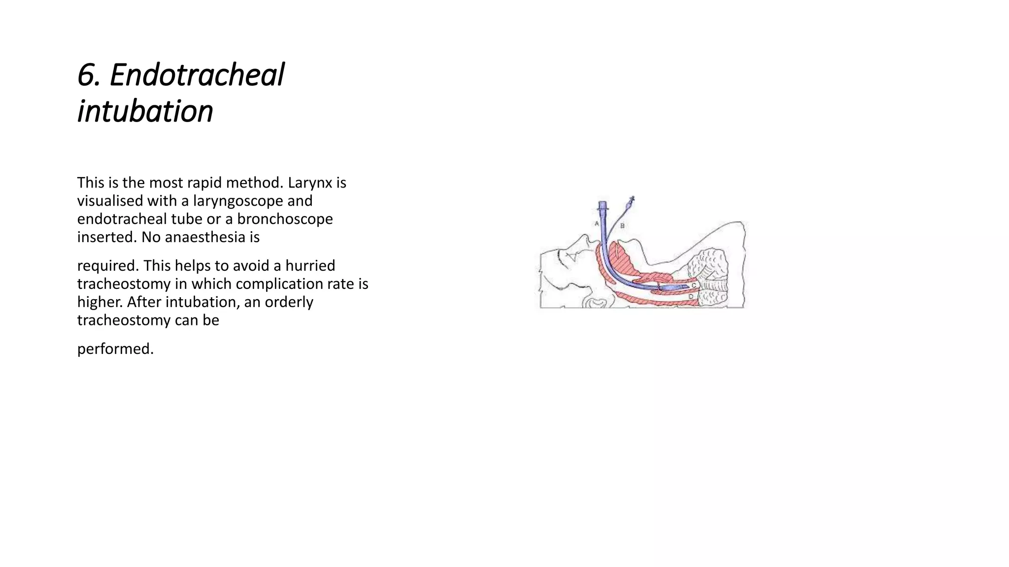 Tracheostomy ent indications procedure complications ppt | PPTX
