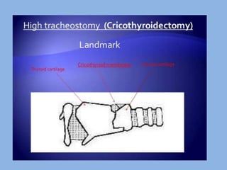 Tracheostomy | PPTX
