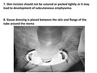 Tracheostomy | PPTX