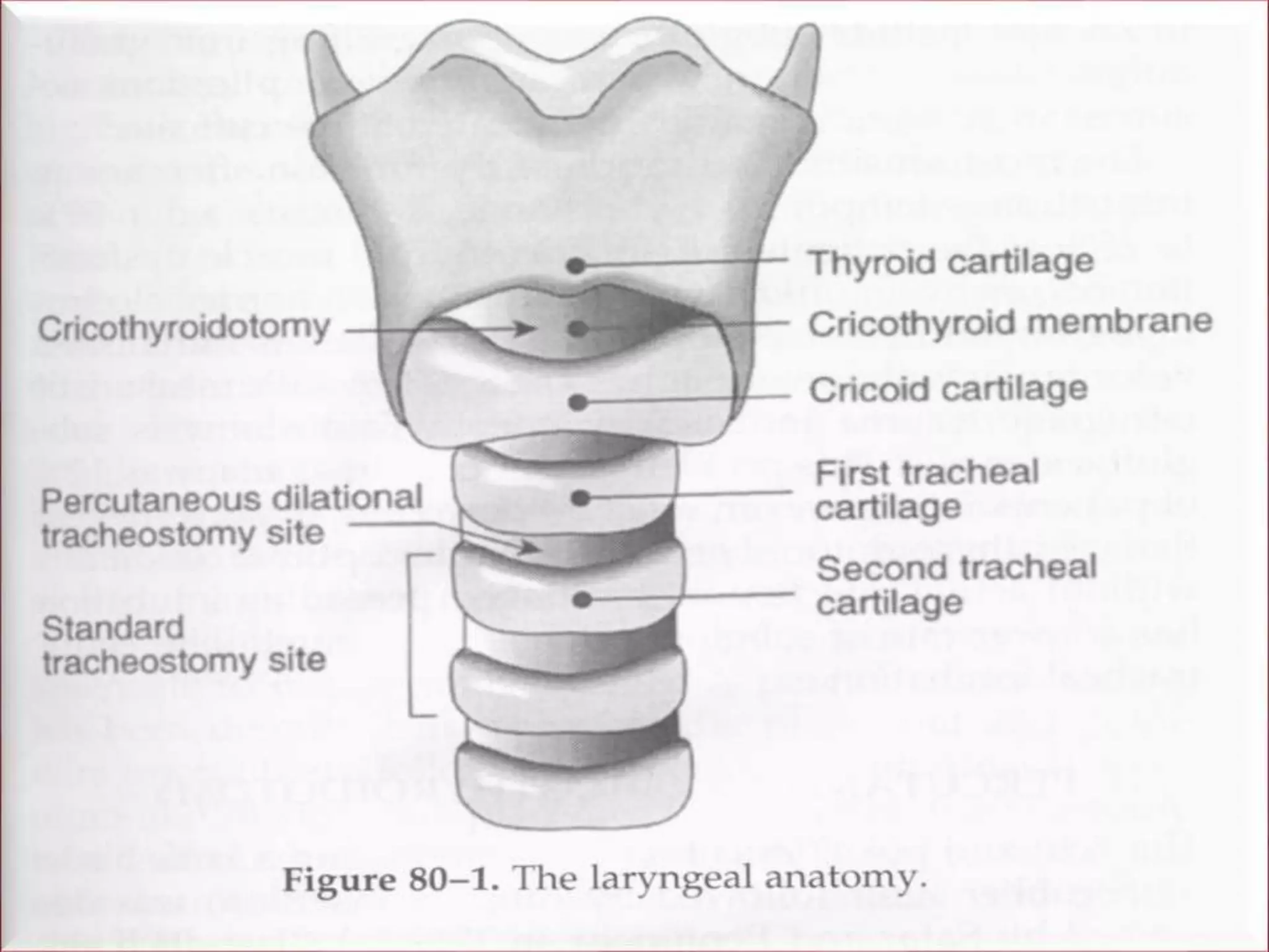 TRACHEOSTOMY BY DR JUVERIA MAJEED MS ENT | PPTX
