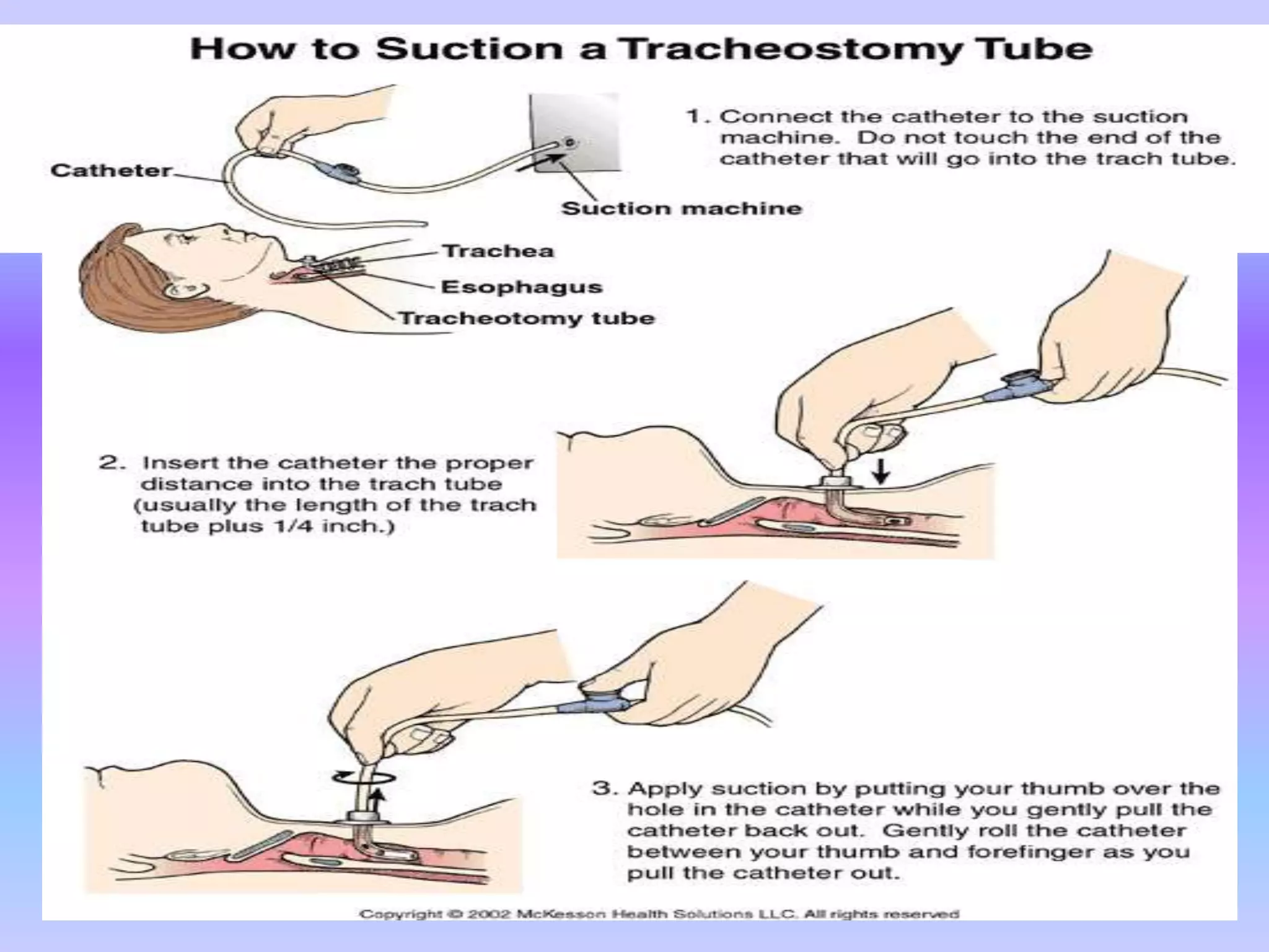 Tracheostomy | PPTX