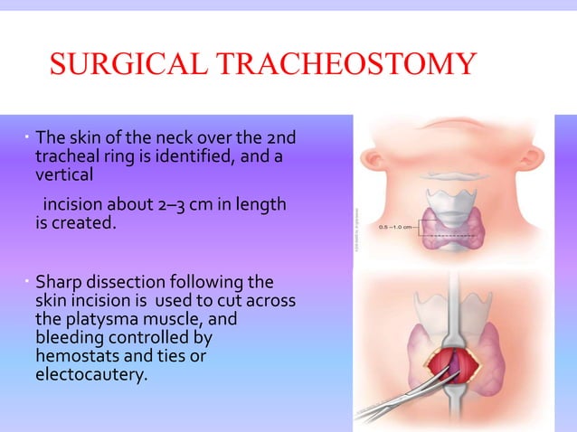 Tracheostomy | PPTX