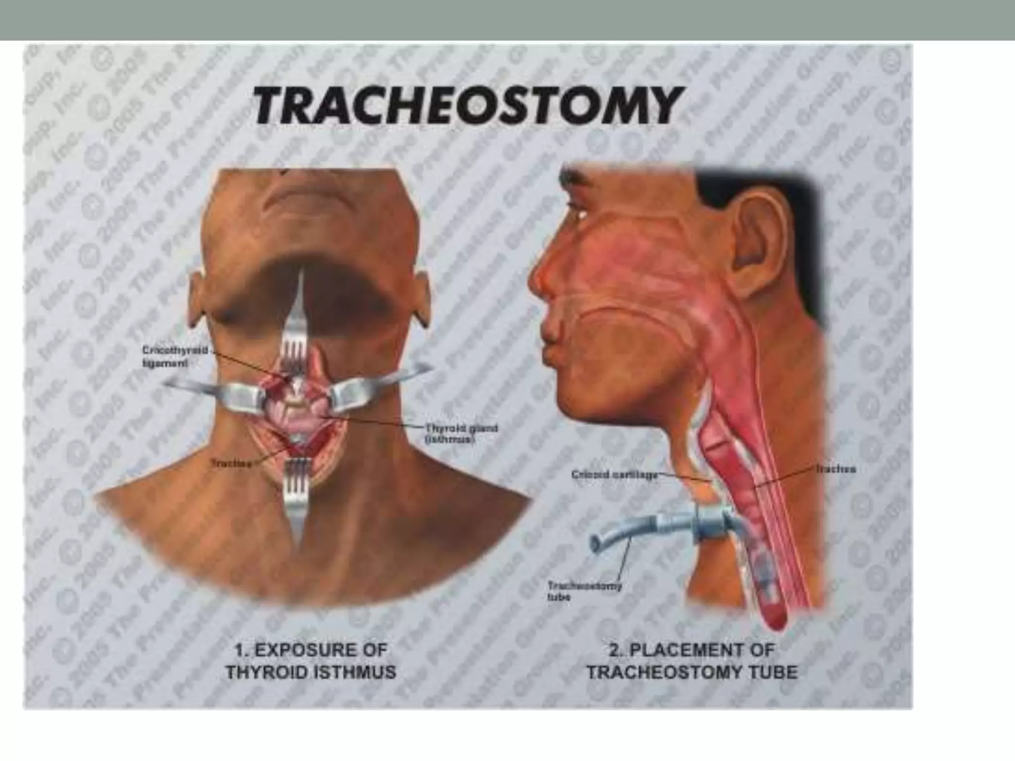 Tracheostomy | PPTX