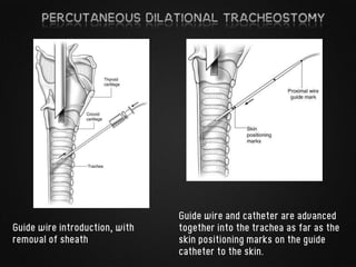 Tracheostomy | PPTX | Thyroid Disorders | Endocrine and Metabolic Diseases
