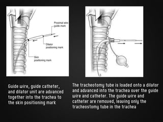 Tracheostomy | PPTX | Thyroid Disorders | Endocrine and Metabolic Diseases