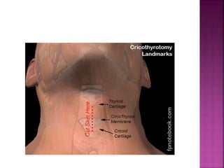 Tracheostomy | PPTX