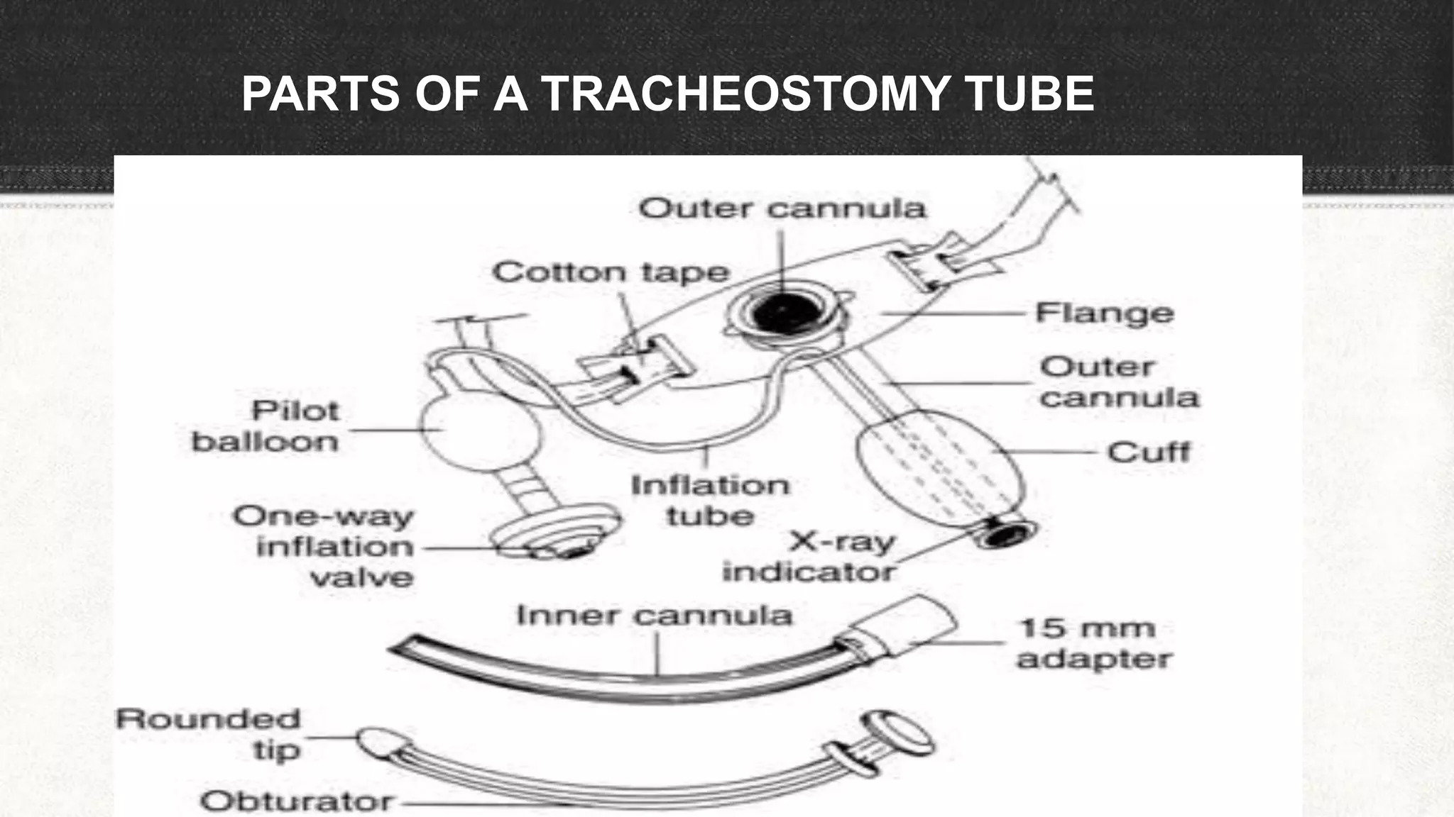 Tracheostomy | PPTX