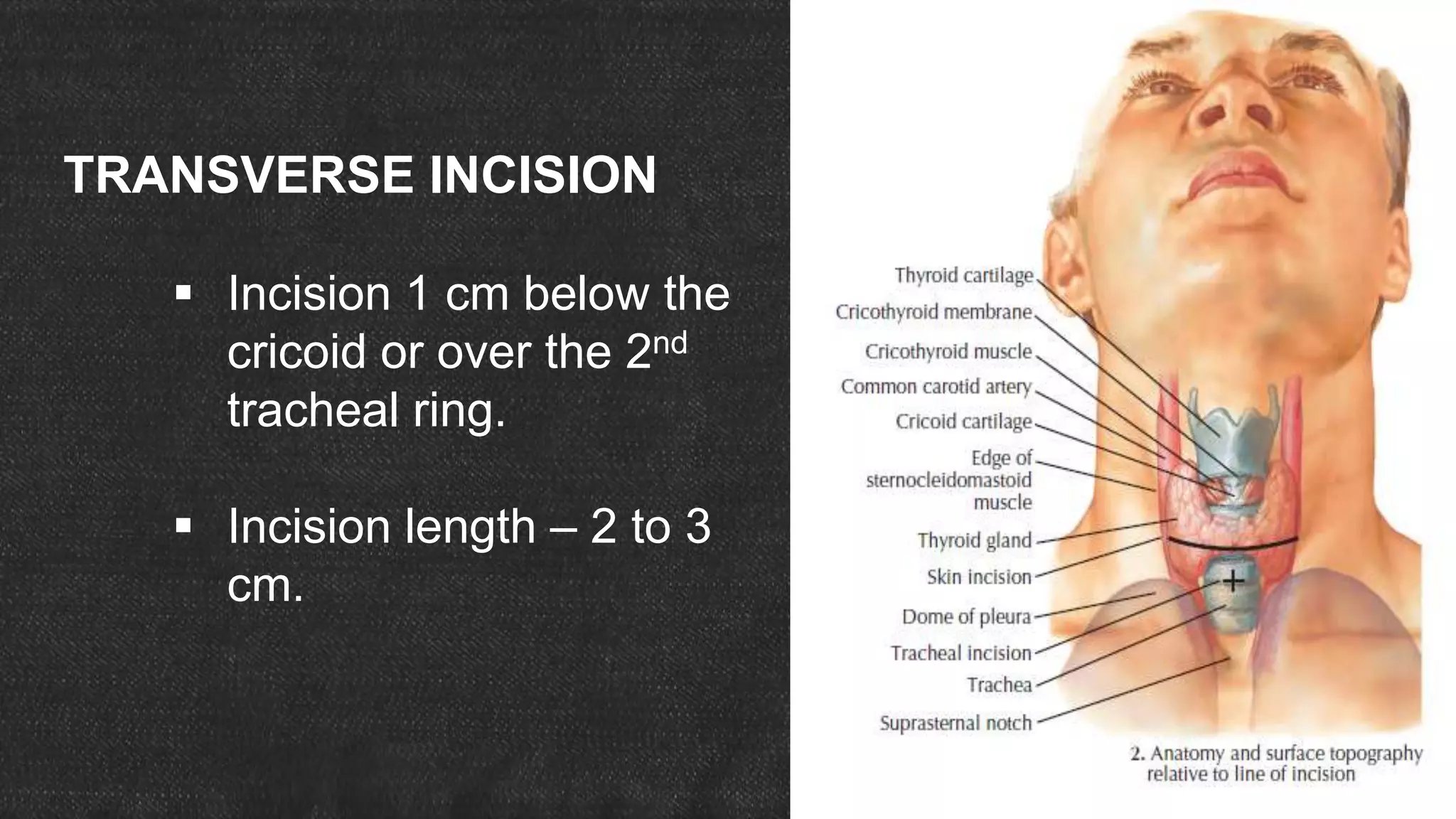 Tracheostomy | PPTX | Lung and Respiratory Health | Diseases and Conditions